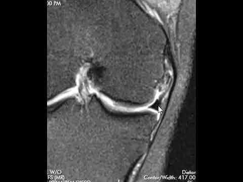 Medial collateral ligament anatomy on MRI.