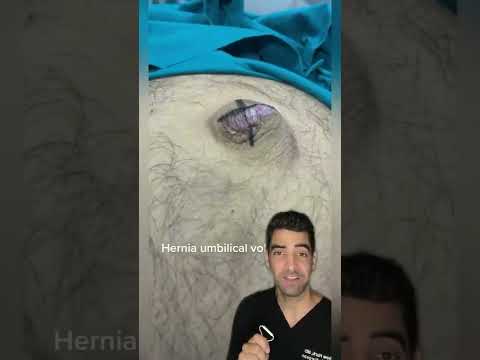 Umbilical Hernia