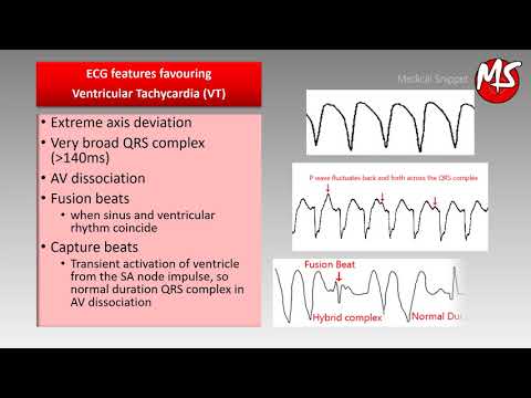 VT on ECG | ACUTE GENERAL INTERNAL MEDICINE