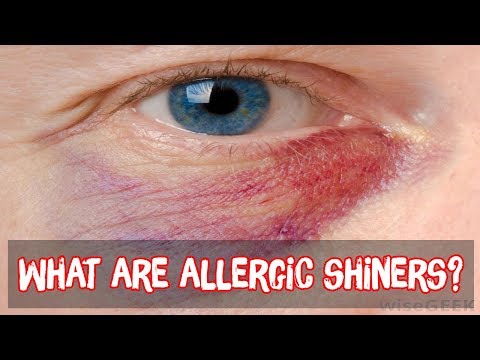 What are allergic shiners?