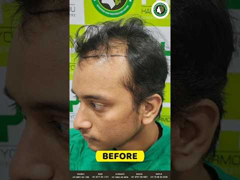 From Balding to Beautiful: See Our Happy Patient Hair Transplant Story #hairtransformation #haircare