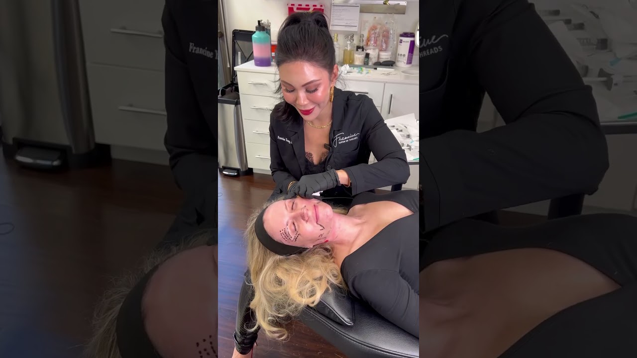 The brow lift of your dreams 🤩 I am injecting filler to lift the patients brow and open up the eye