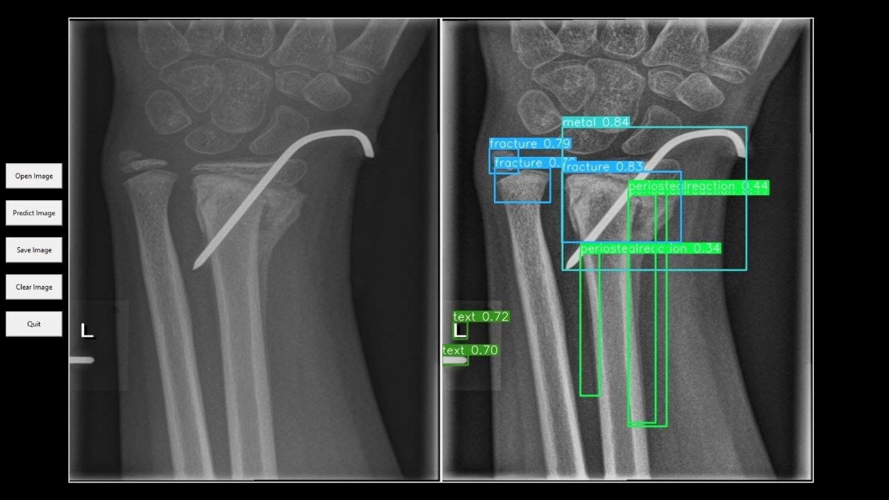 Bone Fracture Detection App