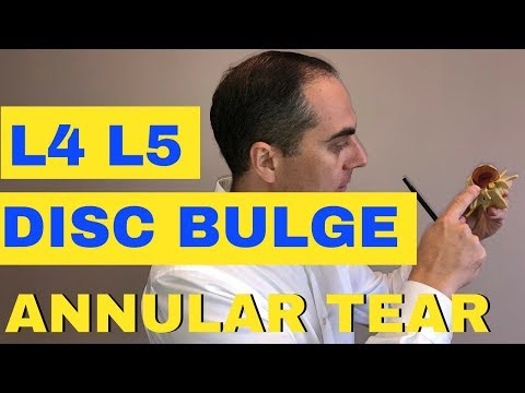 L4 L5 Disc Bulge With Annual Tear What Is An Annular Tear Of The L4 L5 by Chiropractor in Vaughan