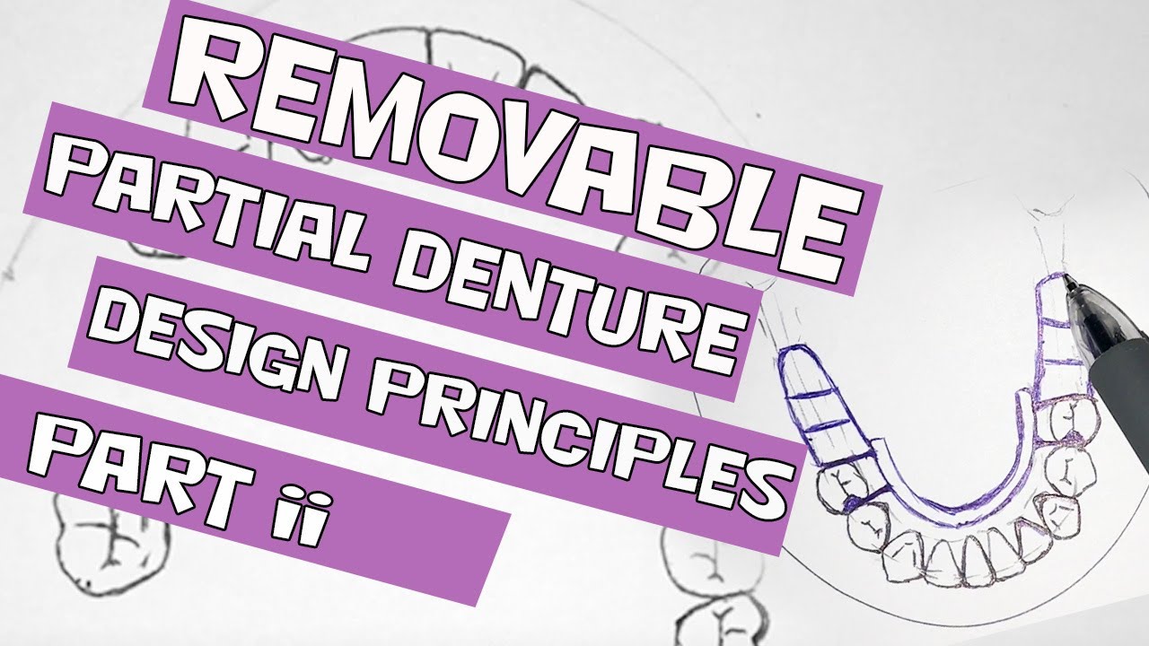 Removable Partial Denture Design Principles Part II