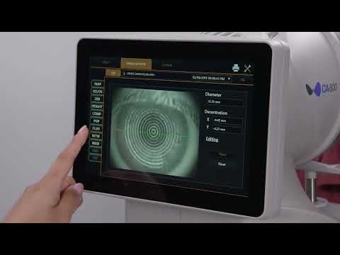 Topcon CA-800: Reviewing White-to-White Data
