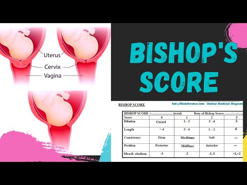 Bishop's Score || Pre Induction Score.