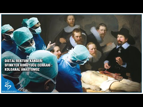 DİSTAL REKTUM KANSERİ SFINKTER KORUYUCU CERRAHİ : KOLOANAL ANASTOMOZ