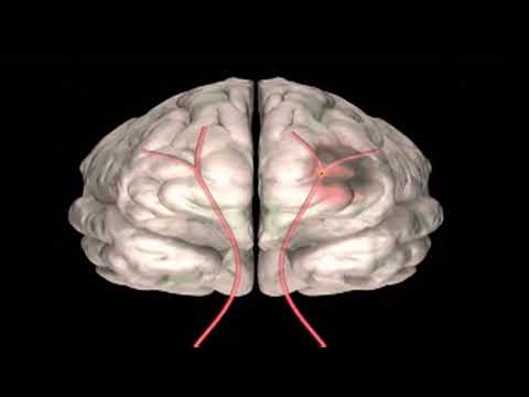 HealthBreak - Watchman Device for Atrial Fibrillation