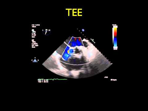 Sinus of Valsalva voiceover