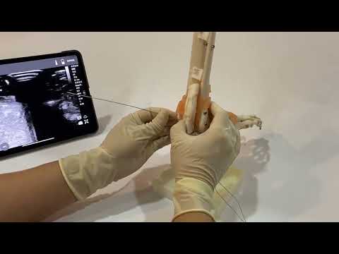 Foot & Ankle International - Ultrasonography-Guided Minimally Invasive Surgery for Achilles