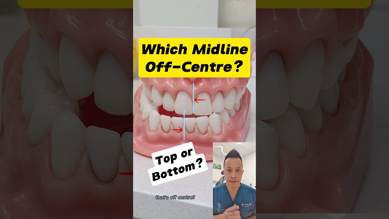 Is Your Top or Bottom Dental Midline Off-Center? How to Tell! #dentallan #dentist #shorts