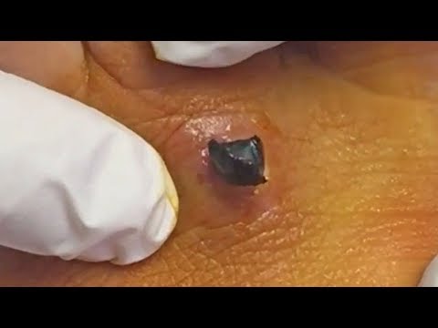 Foot Dilated Pore of Winer Review