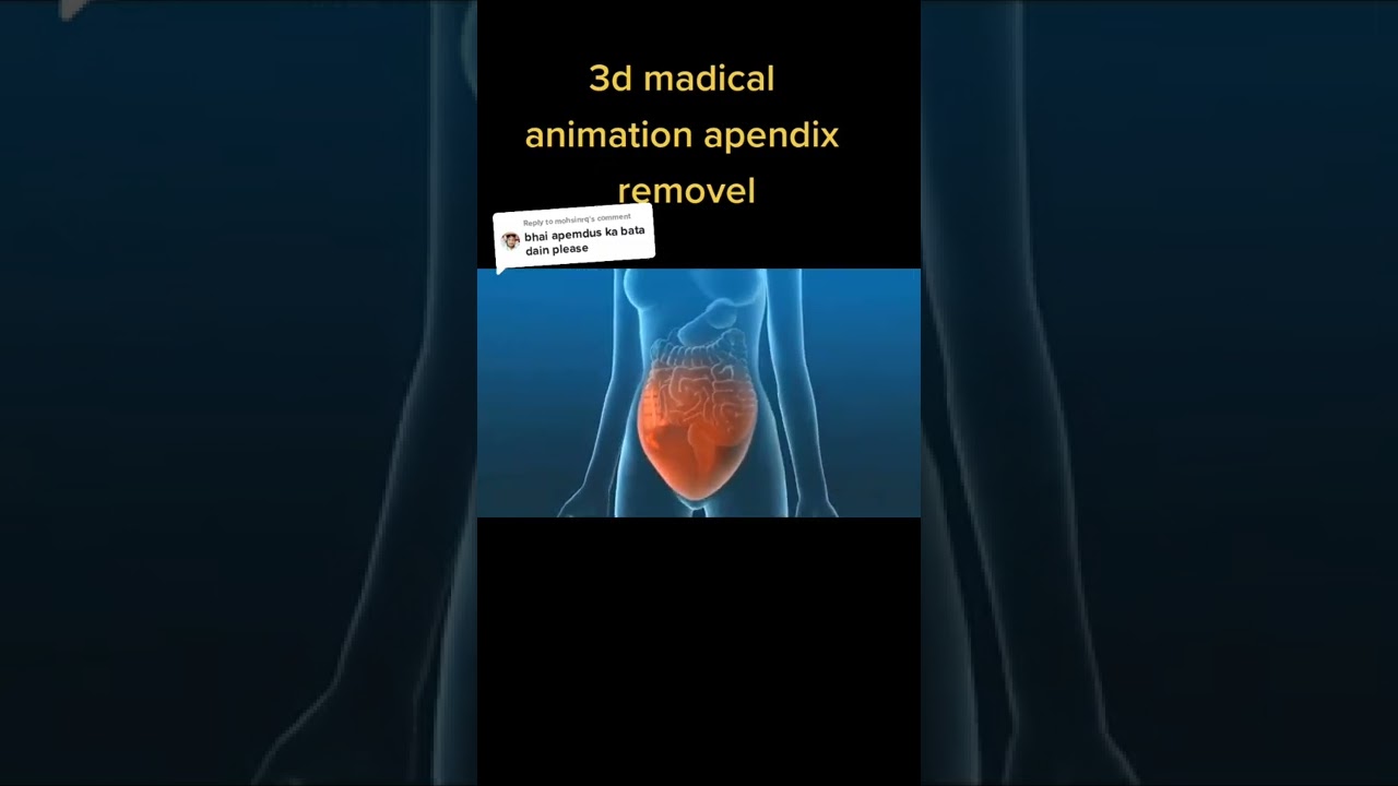 removing appendix #shorts #surgical #viral