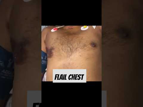 FLAIL CHEST #ribs #fracture #flail #BLUNT #trauma #inspiration #expiration #mrcp #neetpg2025