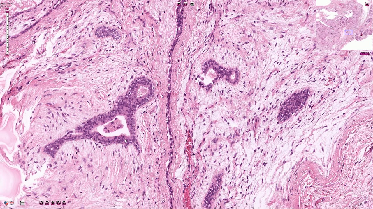 Fibroadenoma - Histopathology