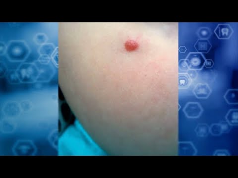 How to Check Your Child’s Moles and When to Worry | Hollywood goodfella