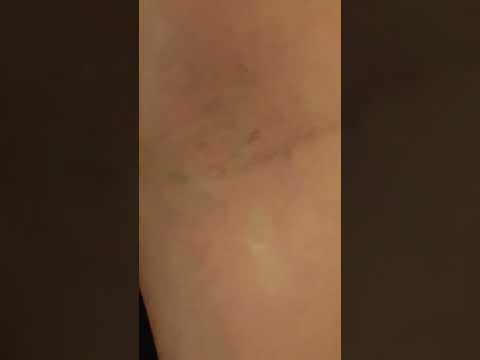 How to mark a vein