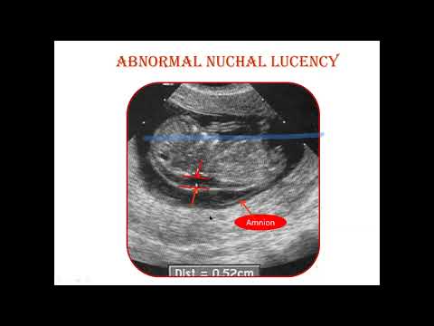 Ultrasound Screening For Fetal Aneuploidies
