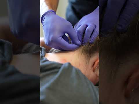 ???? Dry Needling for Headaches. #dryneedling #asmr #needle #running #physicaltherapy #sports