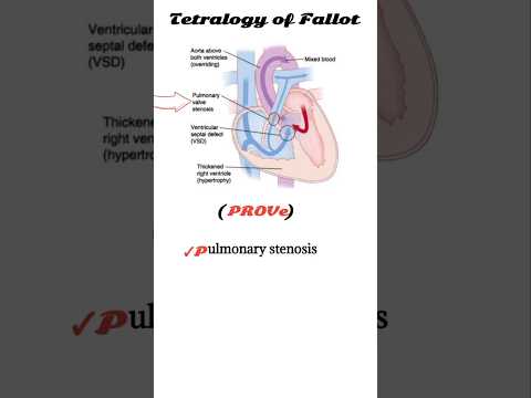 tetralogy of fallot mnemonic | TOF