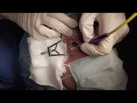 G-Probe Cyclophotocoagulation (CPC)