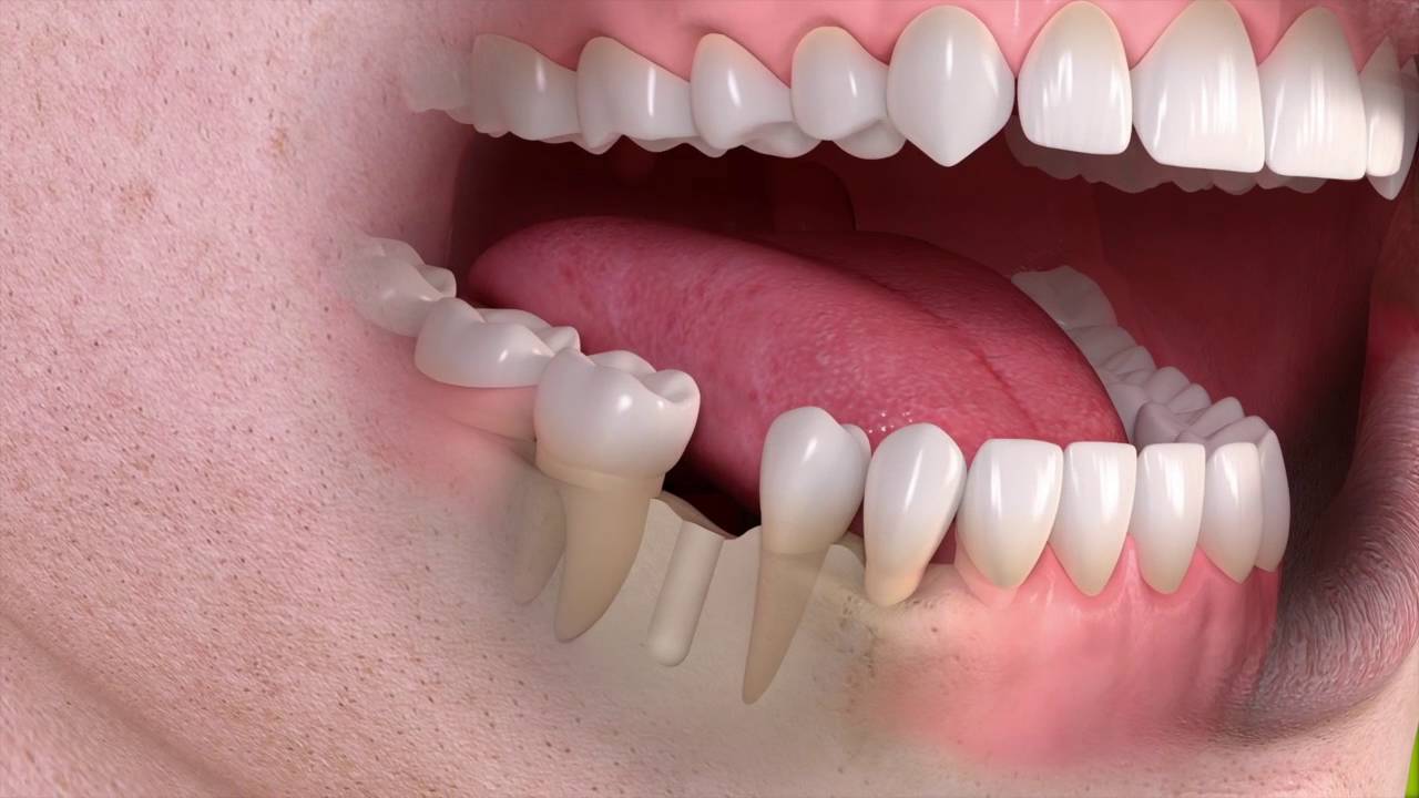 Single Tooth Replacement with a Dental Implant - Dental Implants NYC