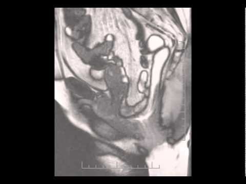 Dynamic MRI showing Enterocele