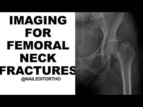 What images should you get for femoral neck fractures?