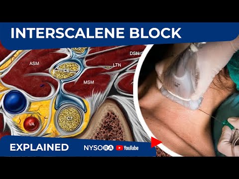 Ultrasound-Guided Continuous Interscalene Brachial Plexus Block - Regional Anesthesia