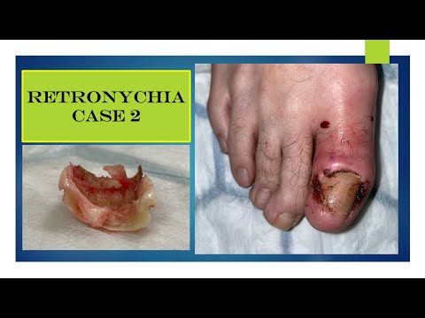 Video - retronychia case 2