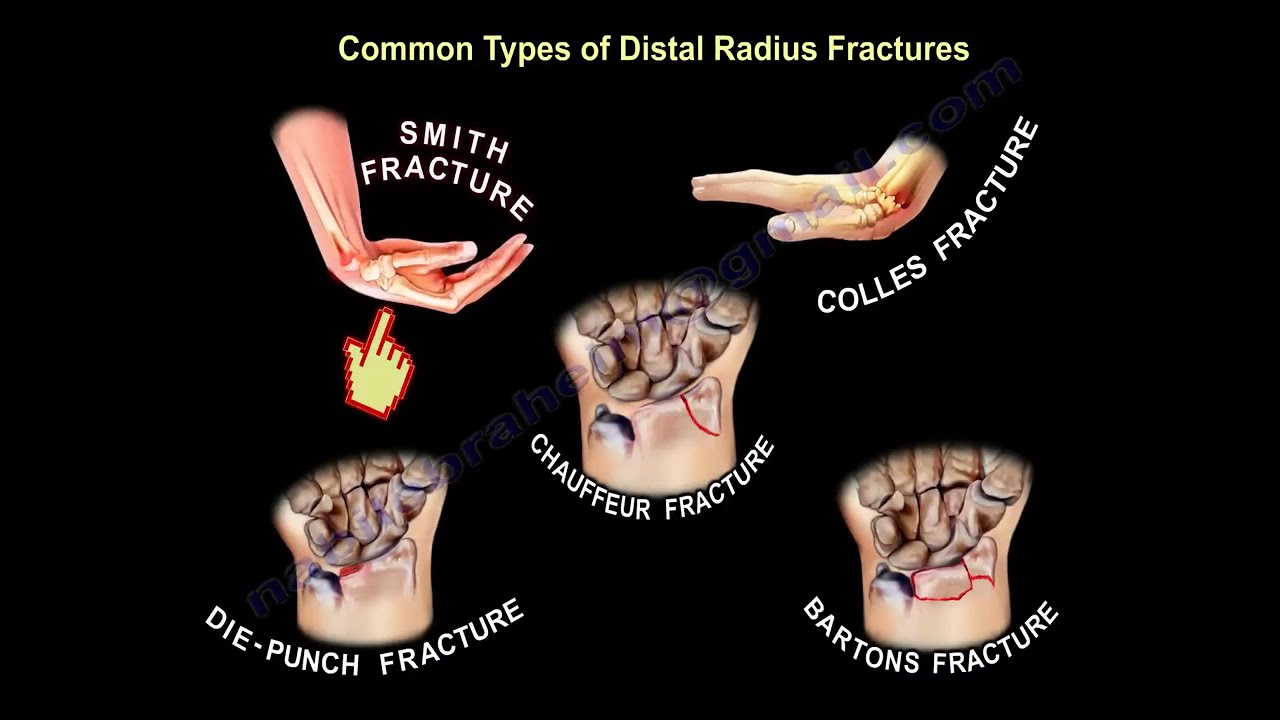 Distal Radius Fracture Types, diagnosis, and treatment.