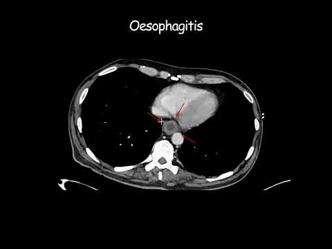 Acute Reporting Series - Oesophagitis #oesophagitis #radiology #radiologist
