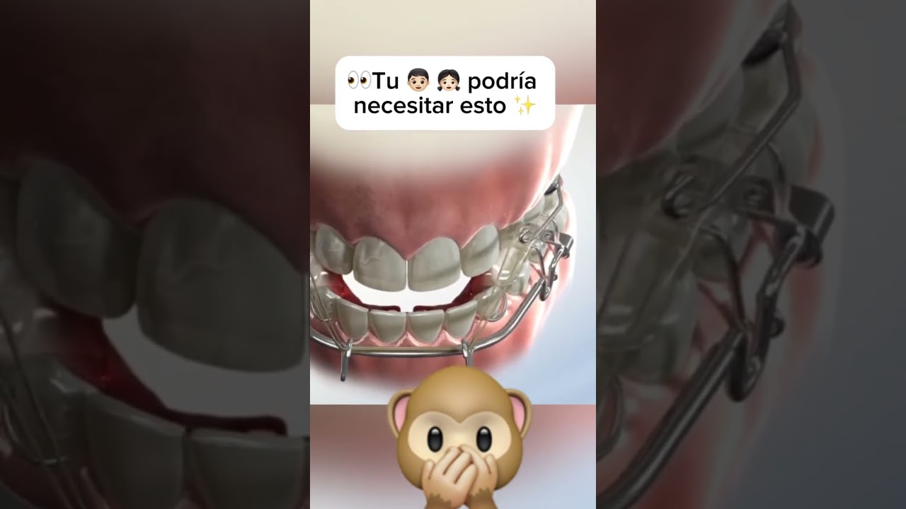 Class III malocclusion #dentist #orthodontist #orthodontics #bracket #orthopedic