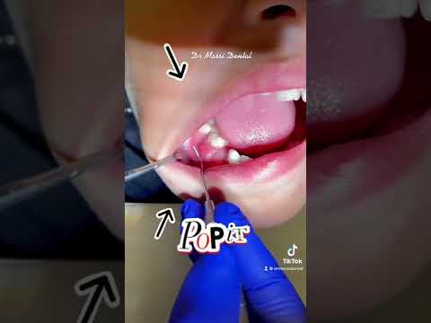 pop It !! Dental abscess