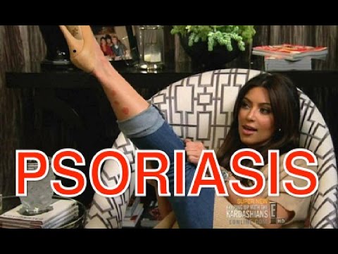 Psoriasis: More than just a rash
