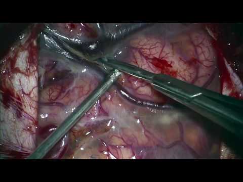 Precentral gyrus /motor area AVM