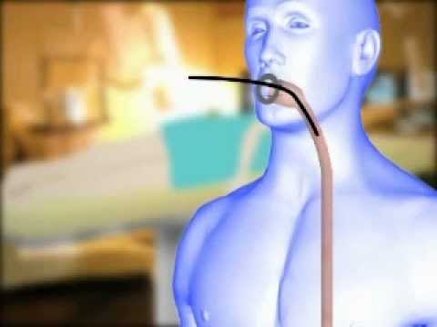 Transesophageal Echocardiogram (TEE)