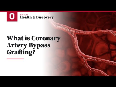 What is Coronary Artery Bypass Grafting (CABG)? | Ohio State Medical Center