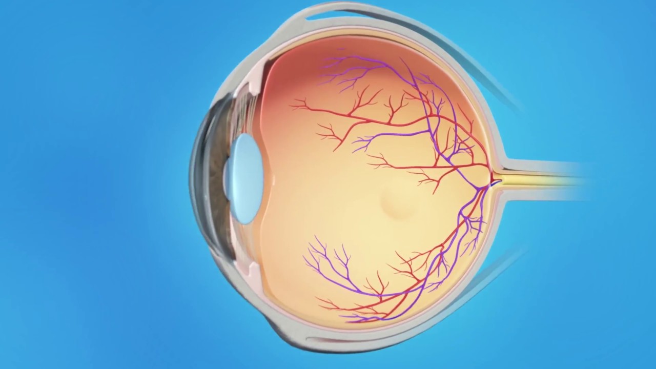 Diabetic PDR Vitrectomy