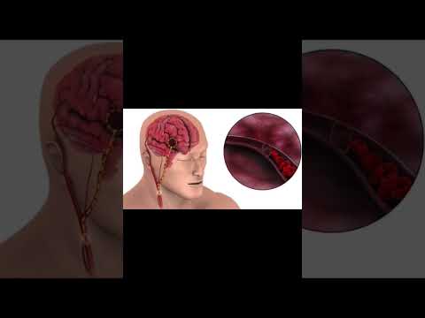 What is ischemic stroke?
