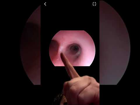 Want to see what your AIRWAY looks like? (Direct Laryngoscopy & Bronchoscopy)