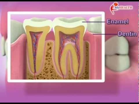 Proses Terjadinya Karies Gigi | Ahmad Adam