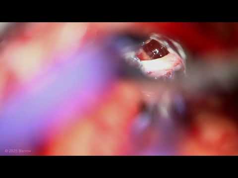 Trans-Middle Cerebellar Peduncle Approach for a Middle Peduncular Pontine Cavernoma Resection