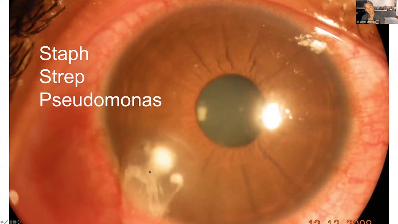 Lecture: Corneal Disease and Dystrophy Management