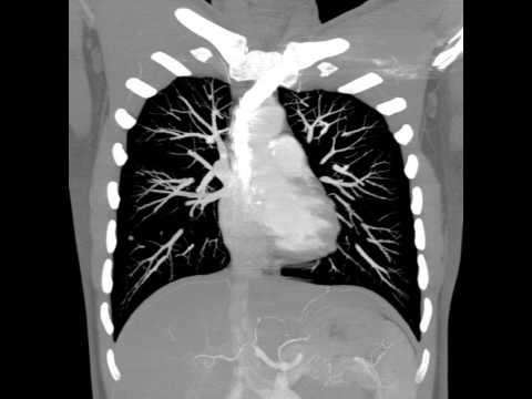 CT Coronal Chest MIP