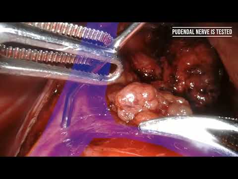 534 3D Model Guided Robot-Assisted Pelvic Neurofibroma Exeresis- Dr. Federico Lavagno