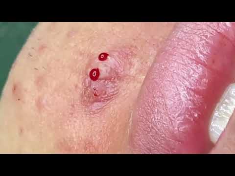 The BEST Acne Treatment Revealed!