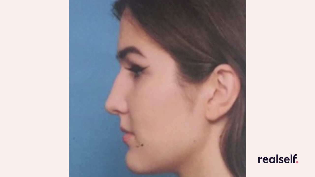 How a Rhinoplasty Fixed My Nose