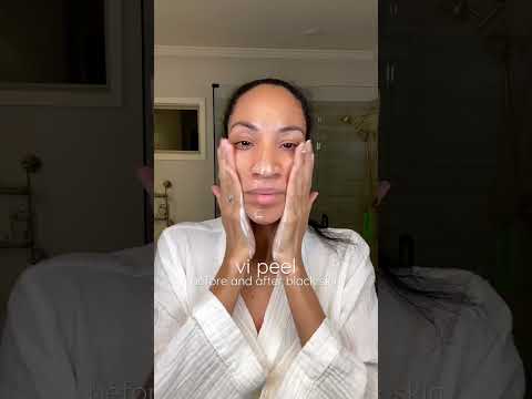 My first vi peel before and after black skin 2023 #skincareshorts